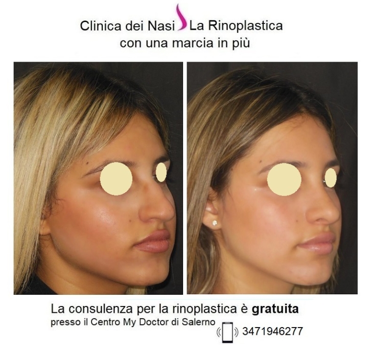 RINOPLASTICA FOTO PRE E POST PAZIENTI OPERATI : NEW RINOPLASTICA IBRIDA ...