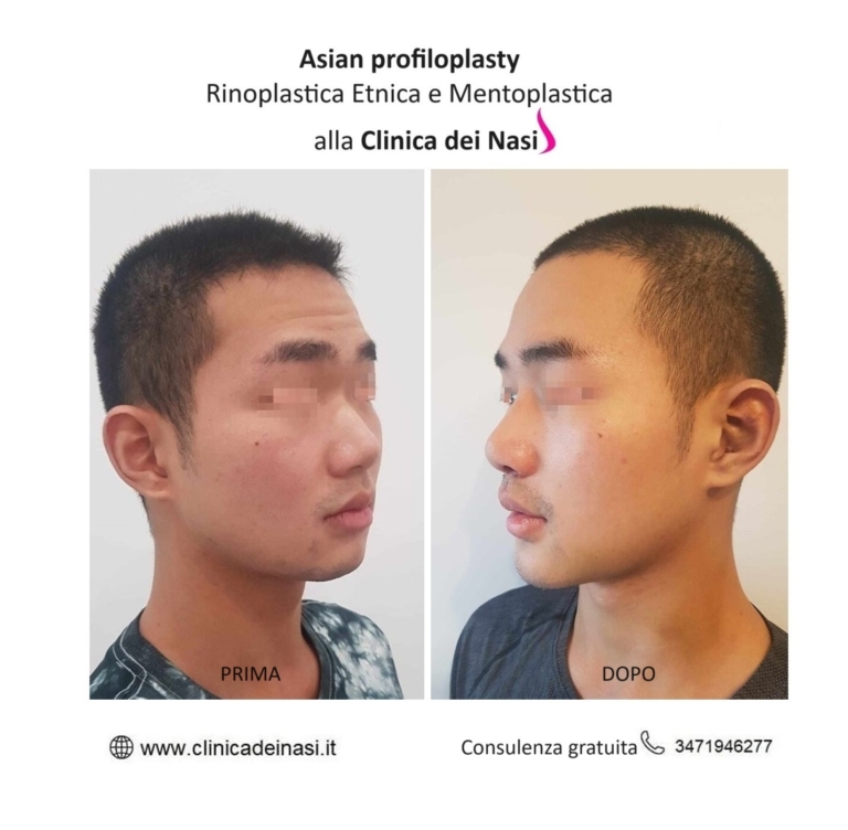 RINOPLASTICA FOTO PRE E POST PAZIENTI OPERATI : NEW RINOPLASTICA IBRIDA ...