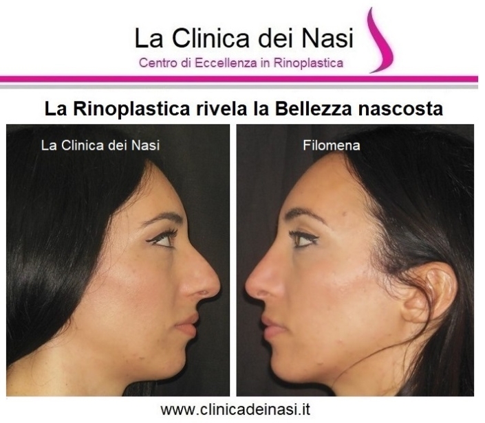 RINOPLASTICA FOTO PRE E POST PAZIENTI OPERATI : NEW RINOPLASTICA IBRIDA ...