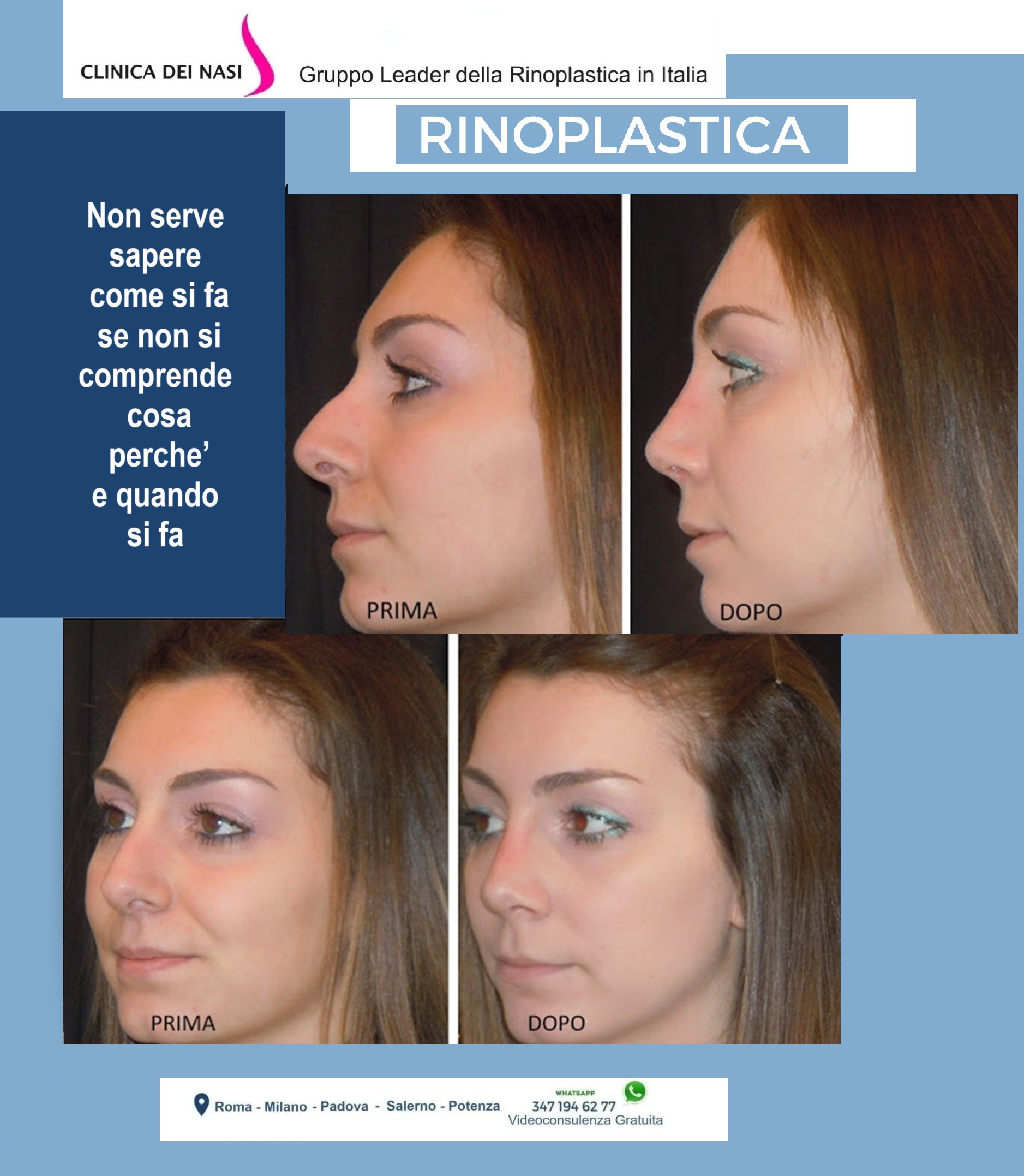 RINOPLASTICA FOTO PRE E POST PAZIENTI OPERATI : NEW RINOPLASTICA IBRIDA ...