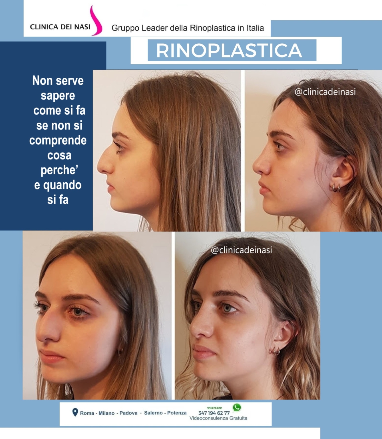 RINOPLASTICA FOTO PRE E POST PAZIENTI OPERATI : NEW RINOPLASTICA IBRIDA ...