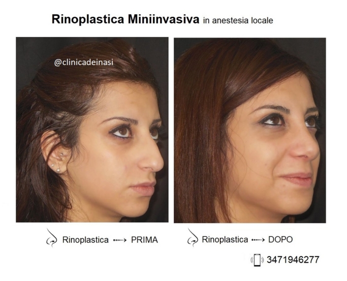 RINOPLASTICA FOTO PRE E POST PAZIENTI OPERATI : NEW RINOPLASTICA IBRIDA ...